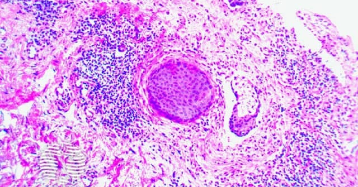 Brunsting-Perry cicatricial pemphigoid pathology image