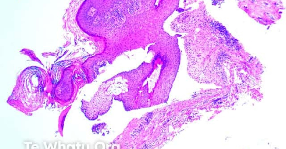 Brunsting-Perry cicatricial pemphigoid pathology image