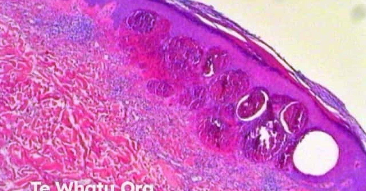 Pathology of cherry angioma image