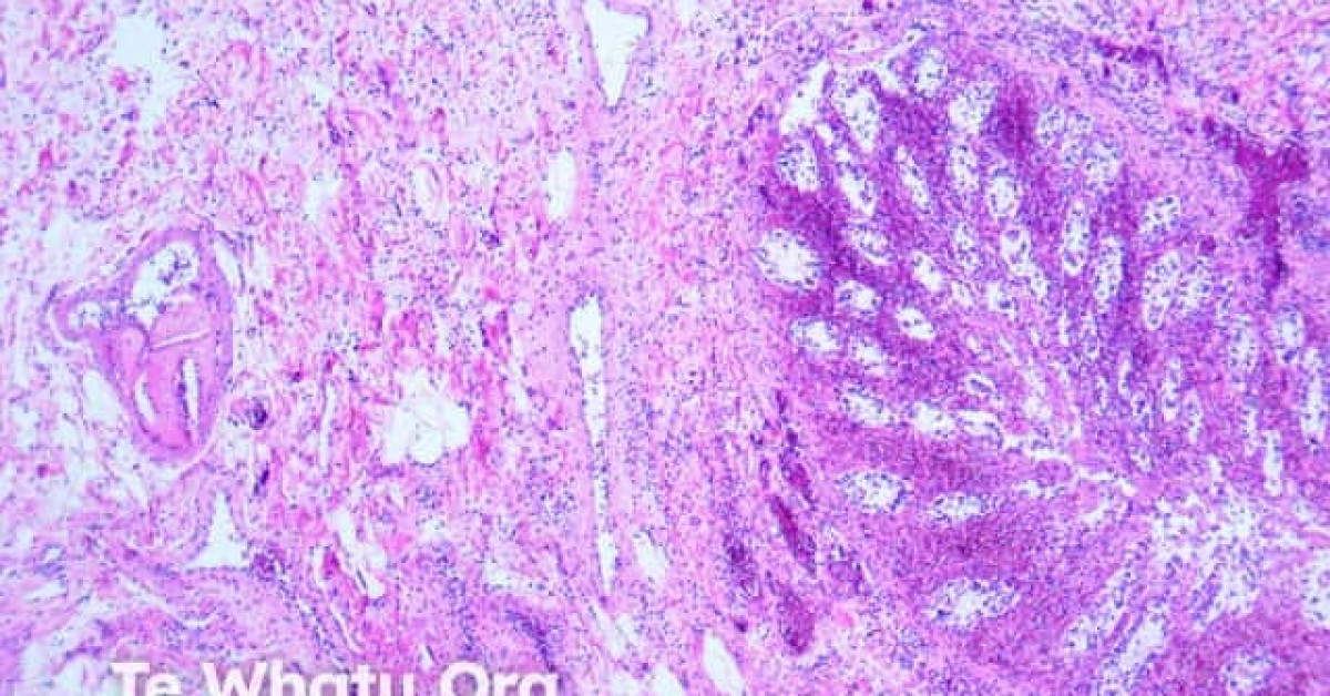 Cholesterol emboli pathology image