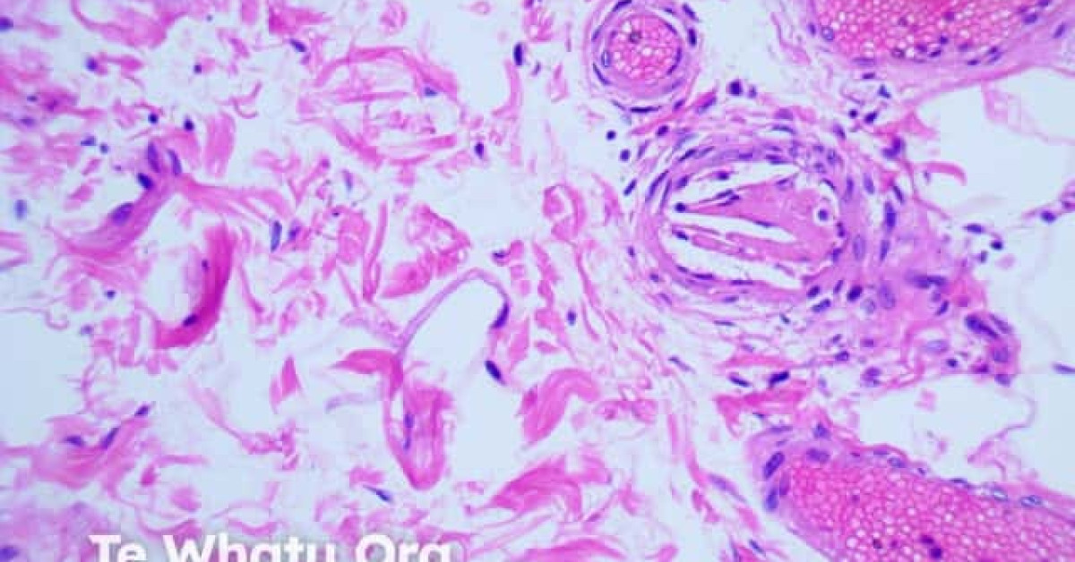 Cholesterol emboli pathology image