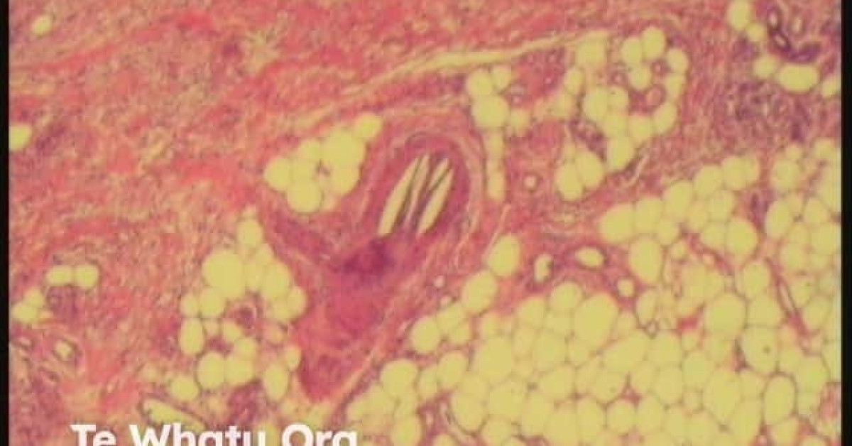 Cholesterol emboli pathology image