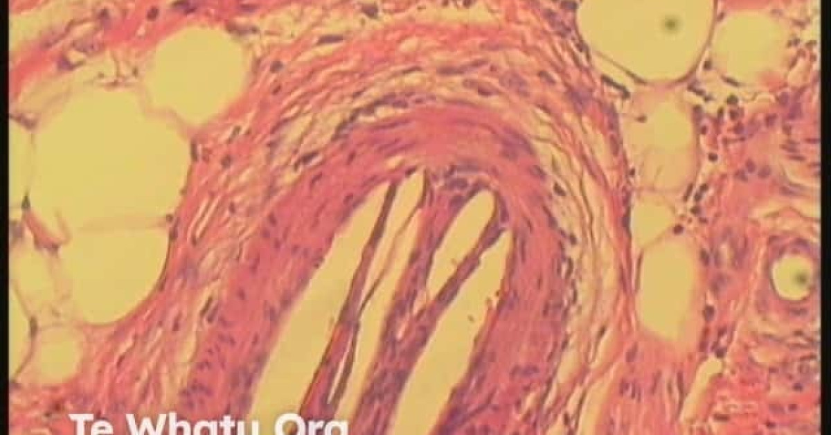 Cholesterol emboli pathology image
