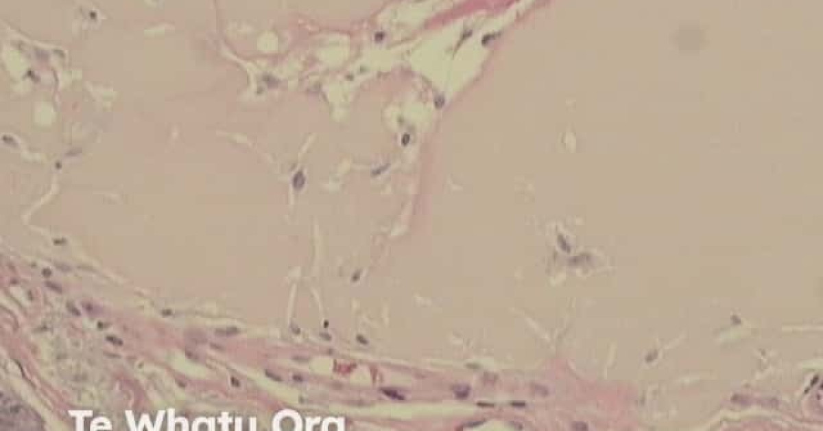 Colloid milium pathology image