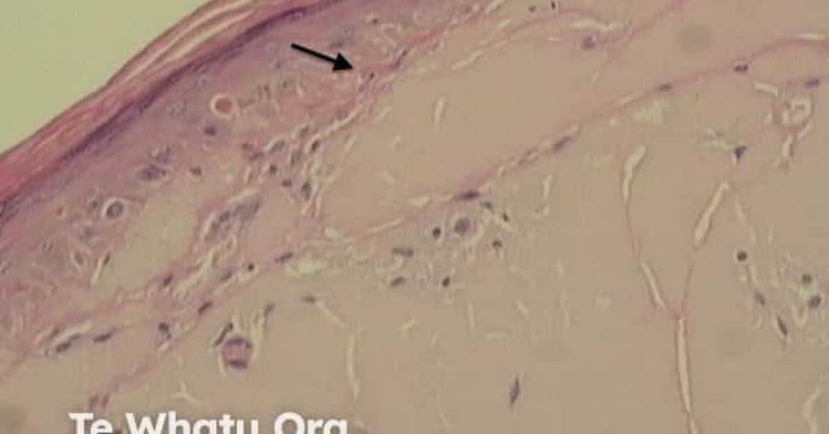 Colloid milium pathology image