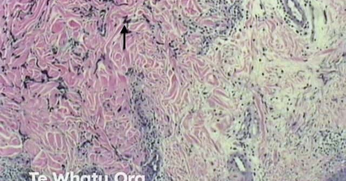 Pathology of cutis laxa image