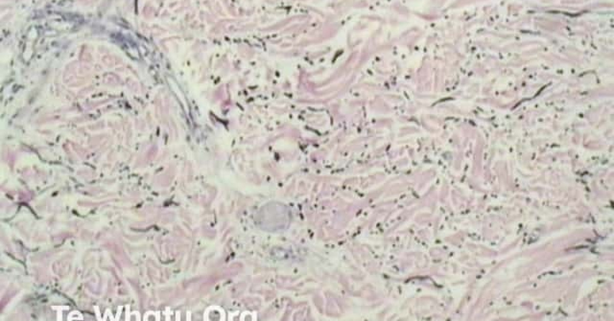 Pathology of cutis laxa image
