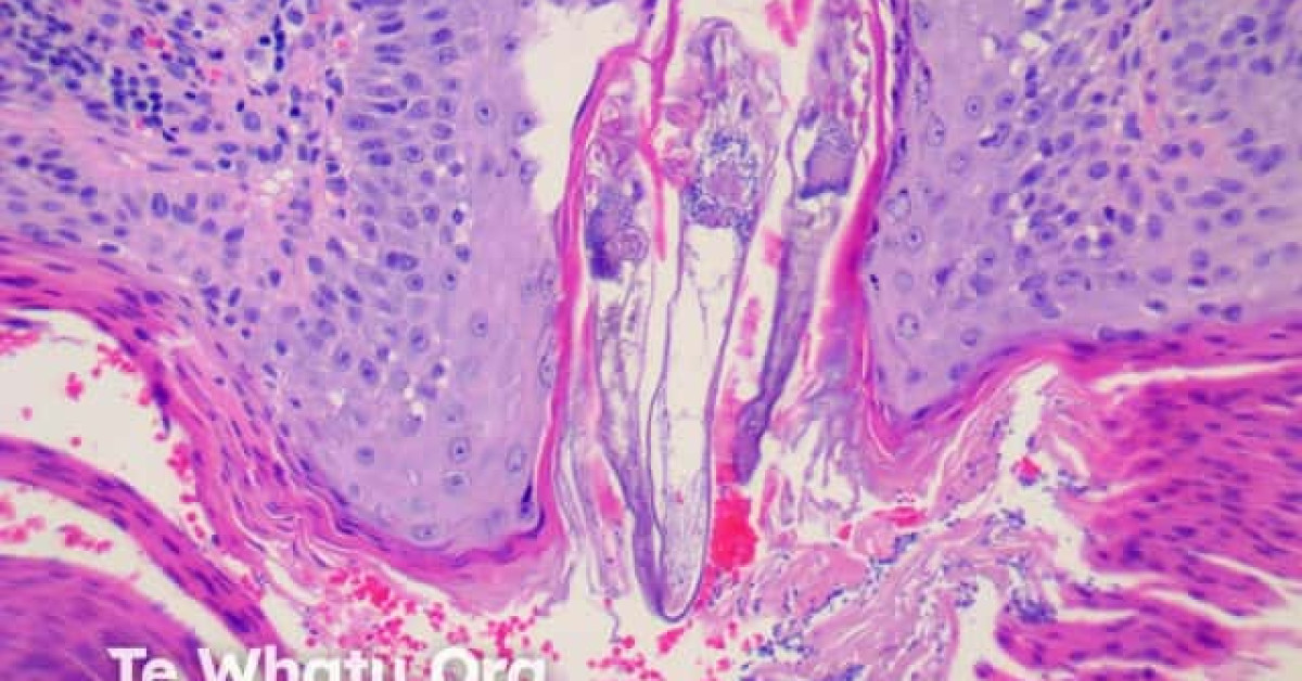 Demodicosis pathology image