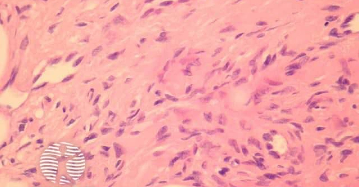Dermatofibrosarcoma protuberans pathology image
