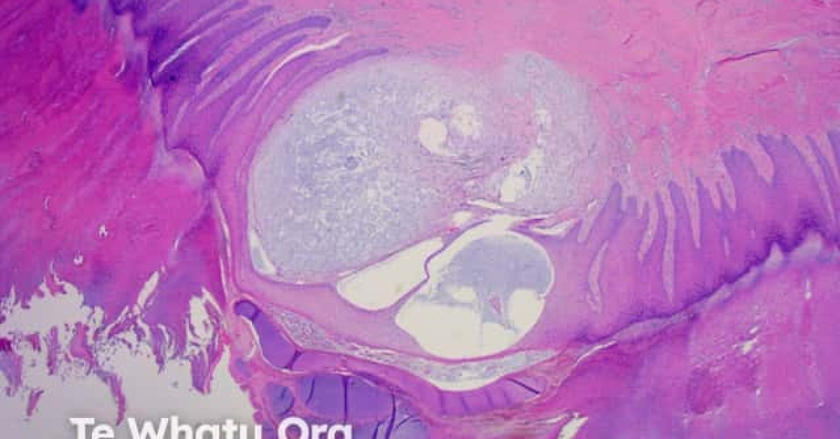 Digital Myxoid Pseudocyst Pathology Image