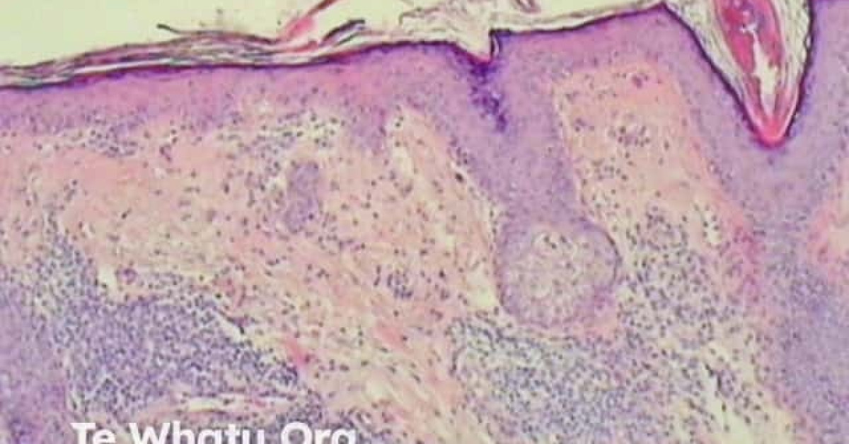 Pathology of discoid lupus erythematosus image