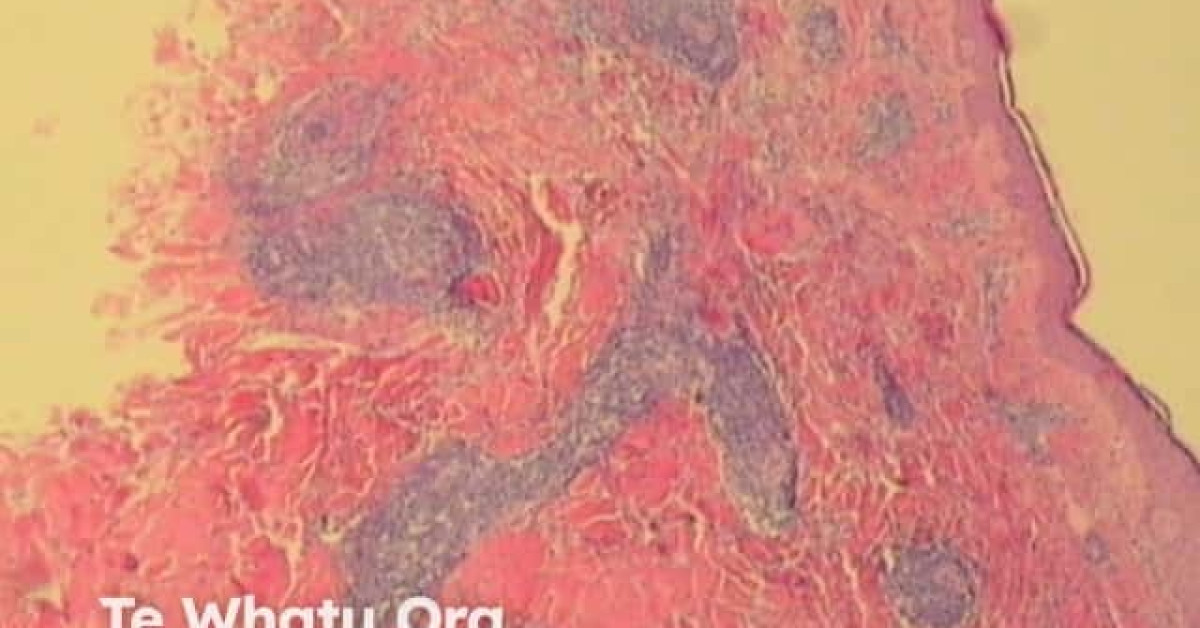 Pathology of erythema annulare centrifugum image
