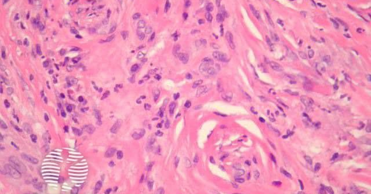 Erythema elevatum diutinum pathology image