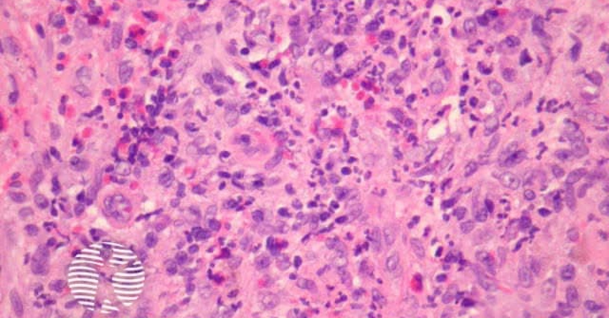 Erythema elevatum diutinum pathology image