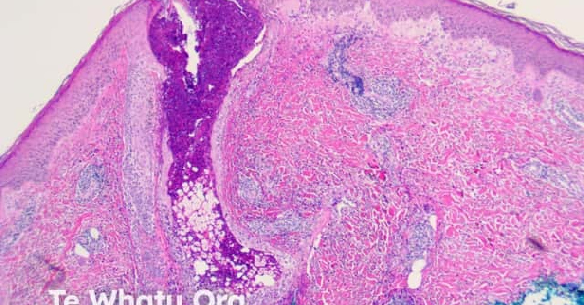 Eosinophilic pustular folliculitis pathology image