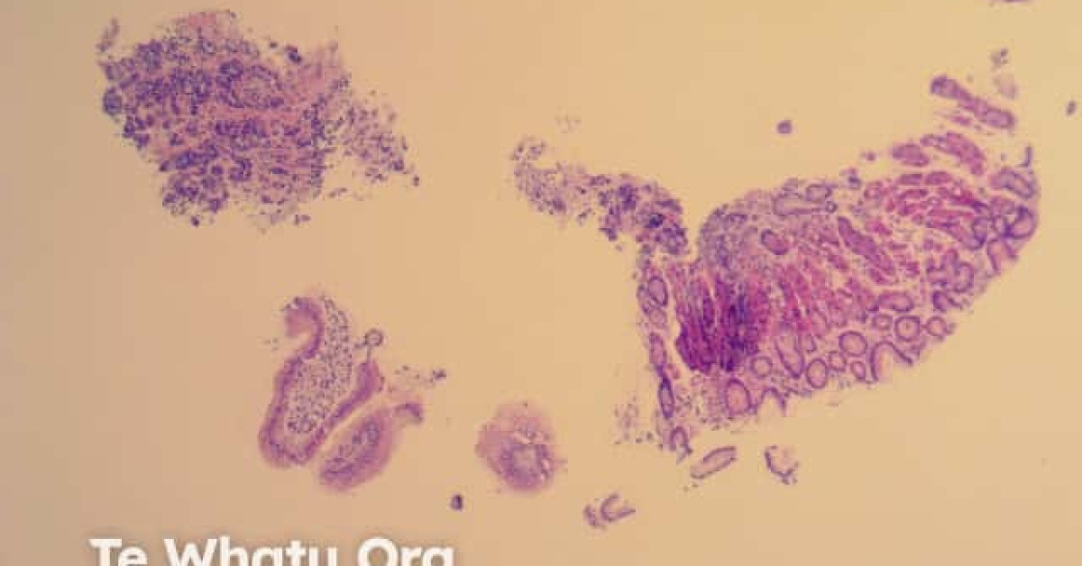 Gastric carcinoid pathology image
