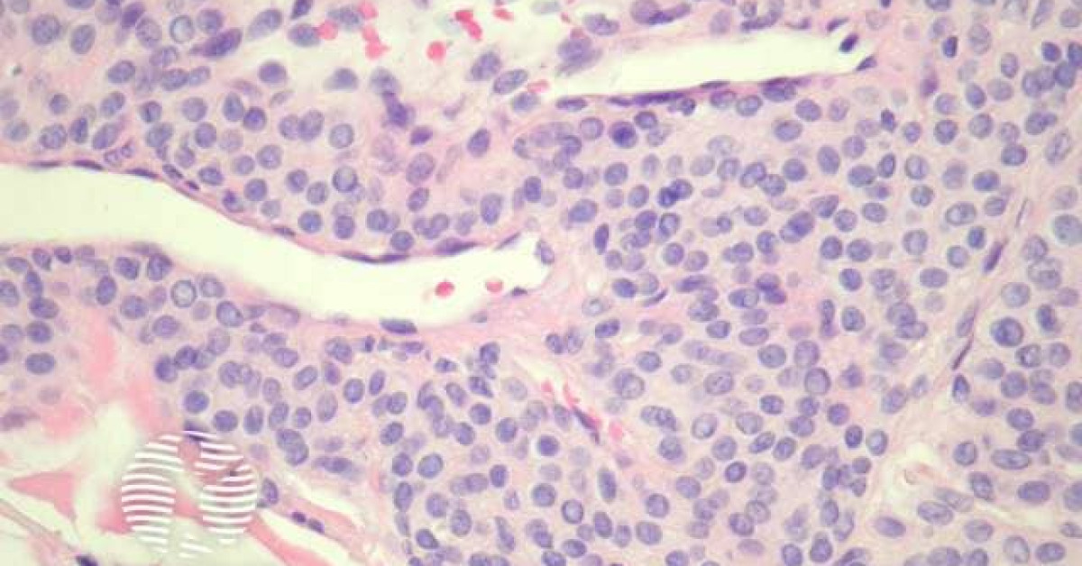 Glomus tumour pathology image