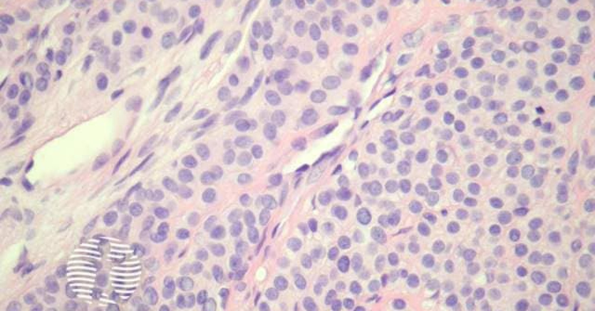 Glomus tumour pathology image