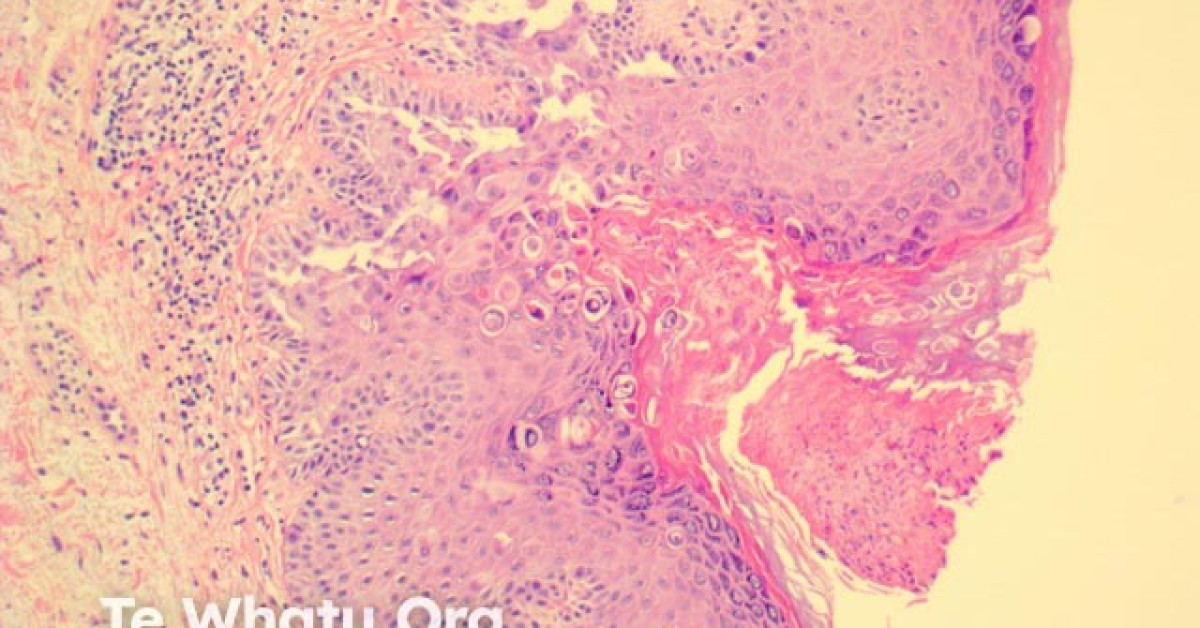 Transient acantholytic dermatosis or Grover disease pathology image