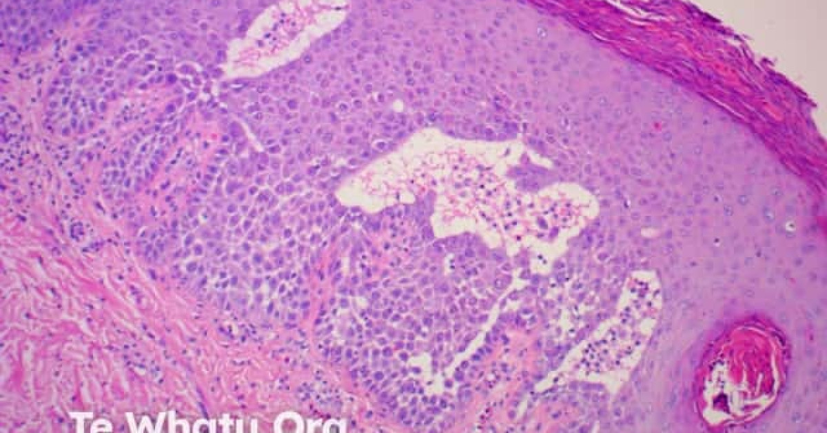 Hailey Hailey disease pathology image