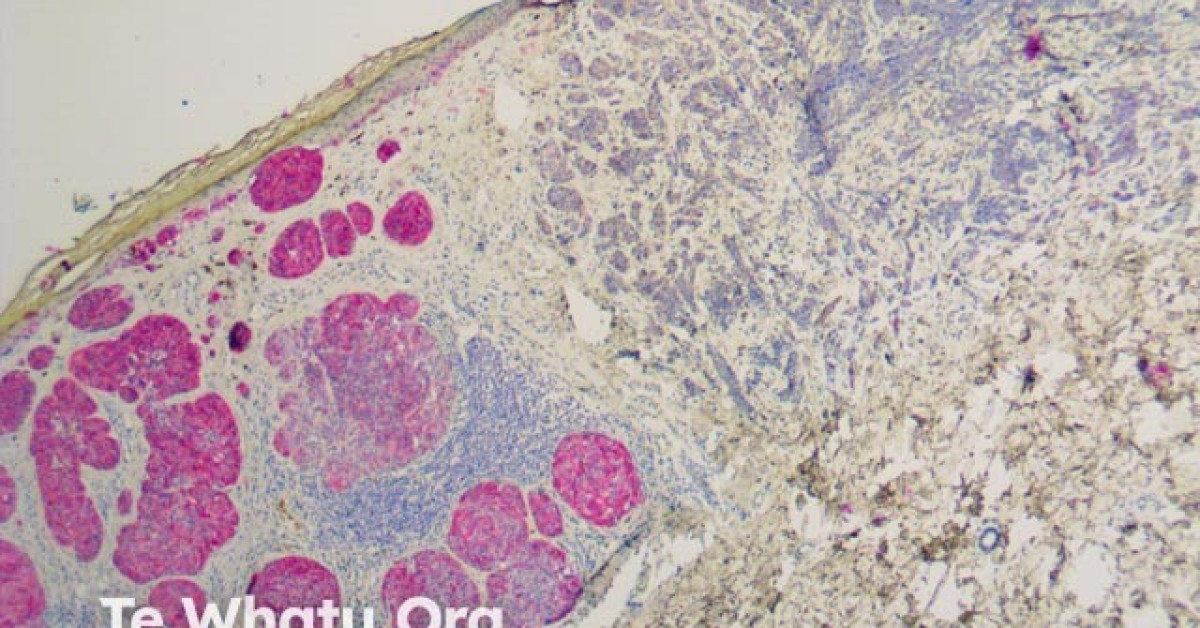 Melanoma stains HMB 45+, and adjacent naevus is negative image