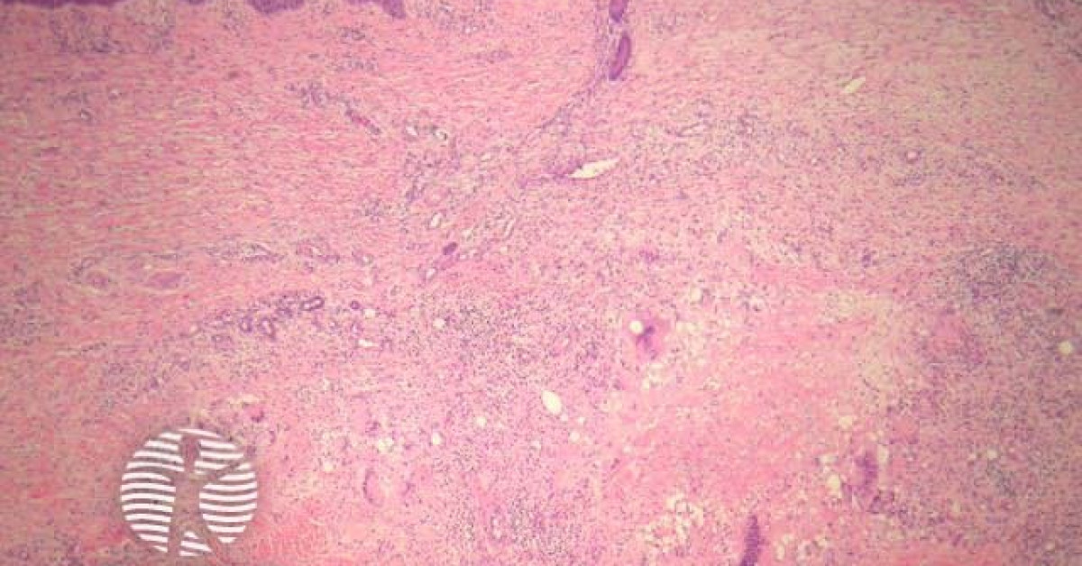 Necrobiotic xanthogranuloma pathology image
