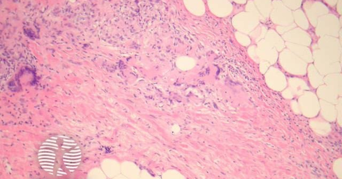 Necrobiotic xanthogranuloma pathology image