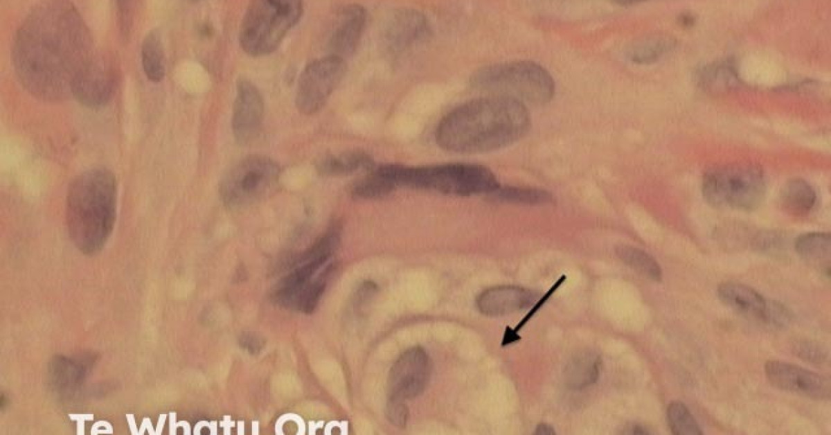 Necrobiotic xanthogranuloma pathology image
