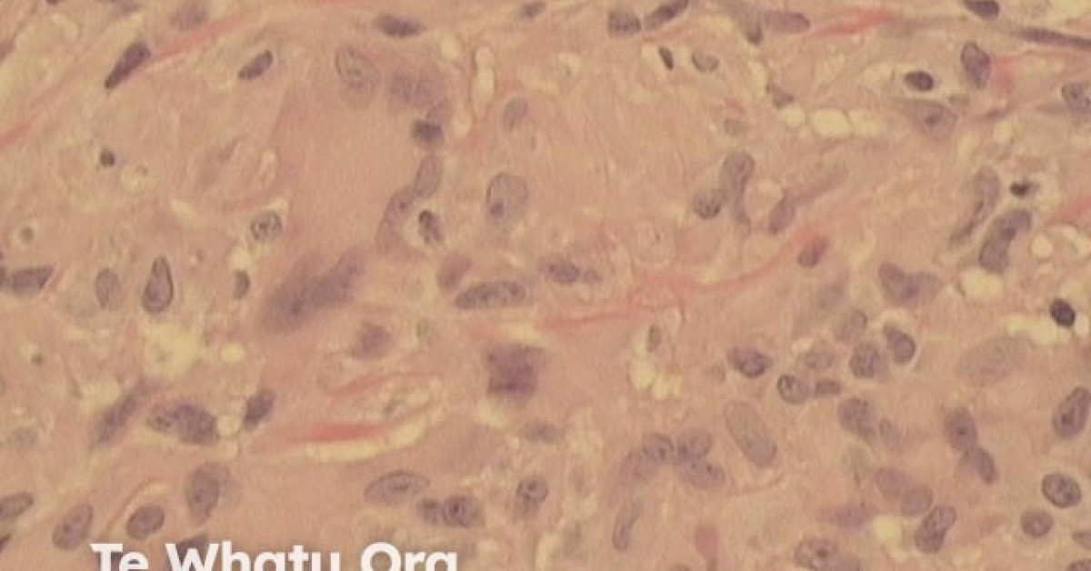 Necrobiotic Xanthogranuloma Histology