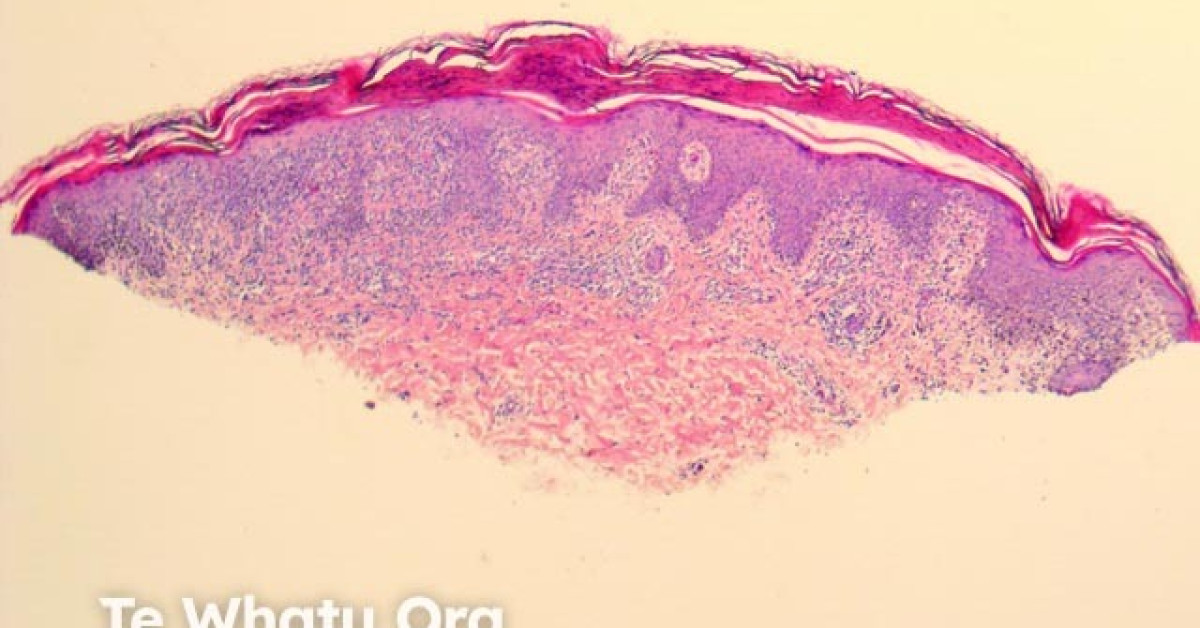 Pityriasis lichenoides et varioliformis acuta (PLEVA) pathology image
