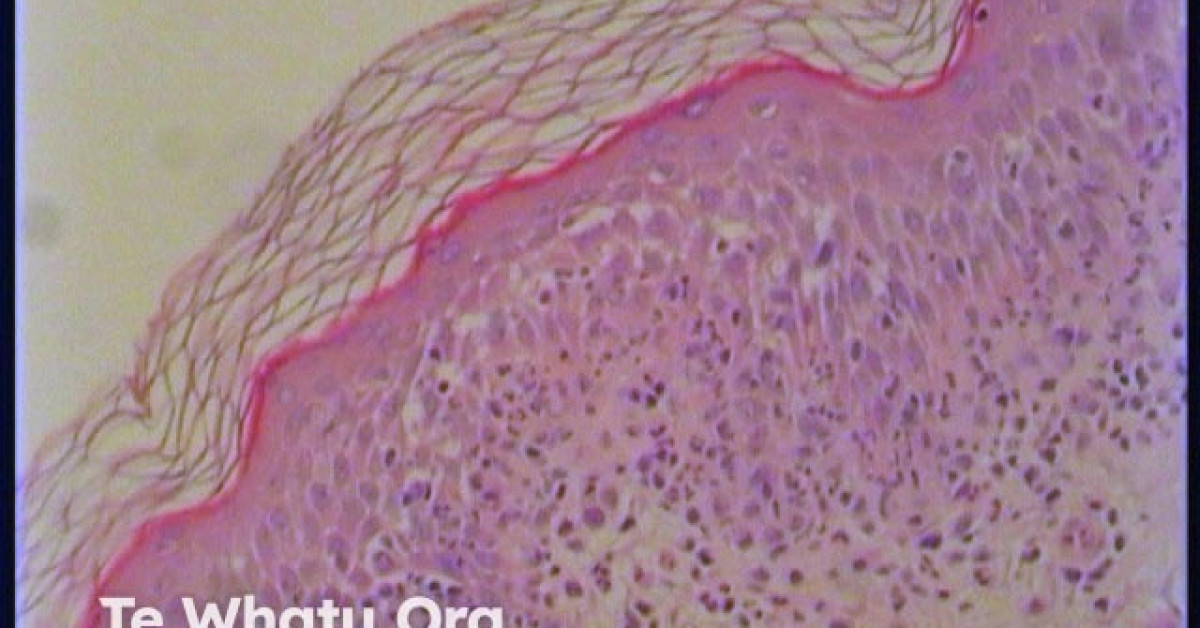 Pathology of toxic epidermal necrolysis image