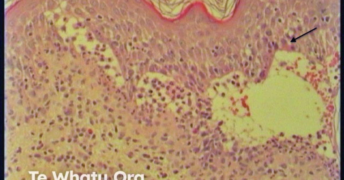 Pathology of toxic epidermal necrolysis image