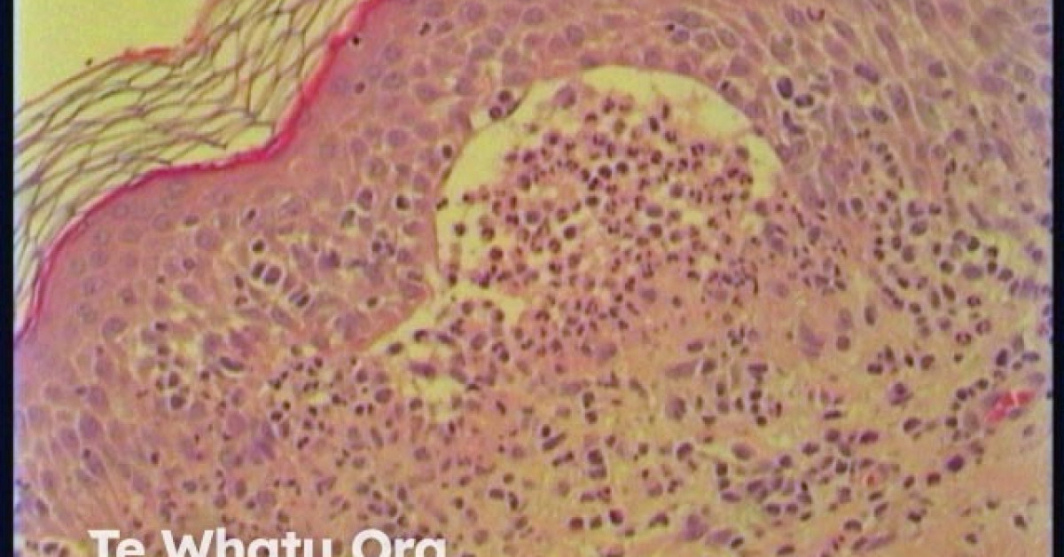 Pathology of toxic epidermal necrolysis image