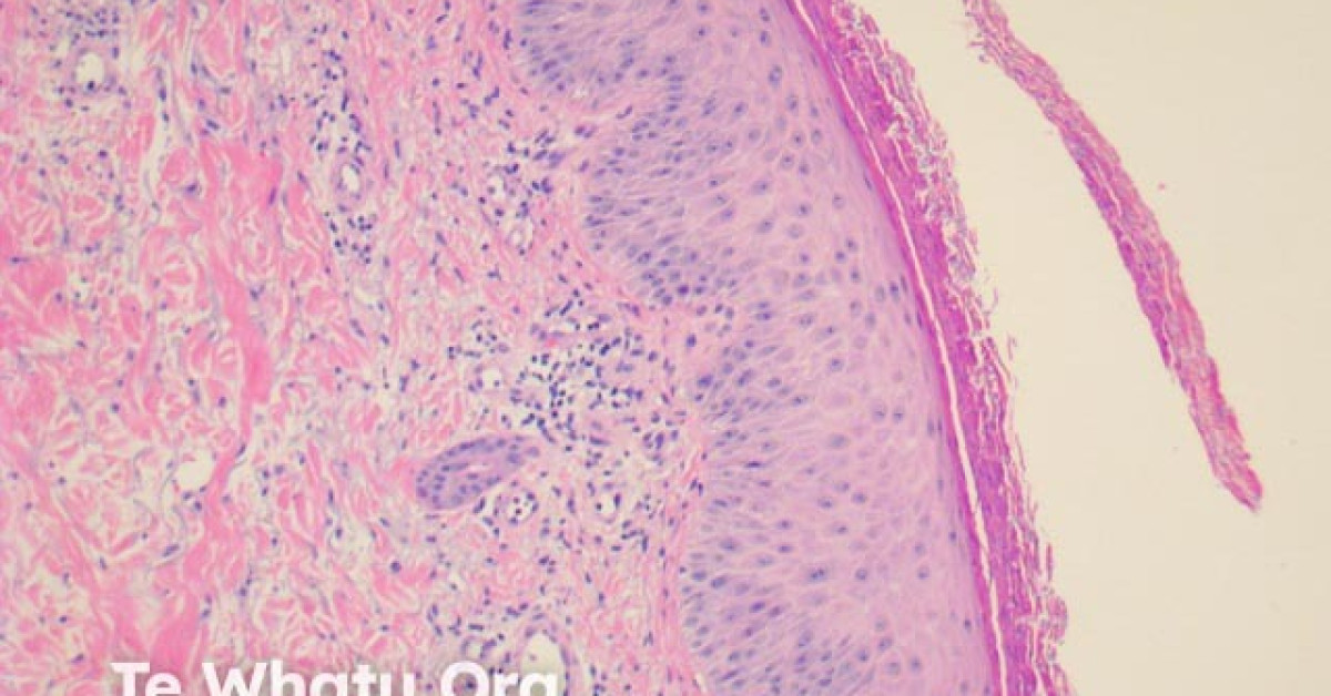 Tinea incognito pathology image