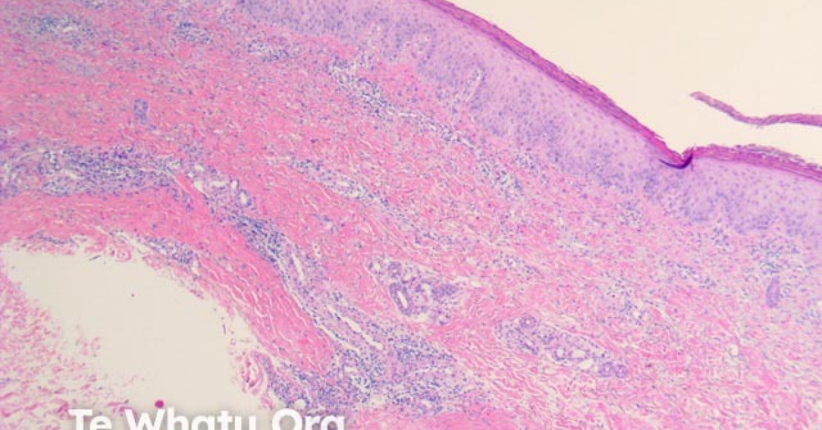 Tinea incognito pathology image
