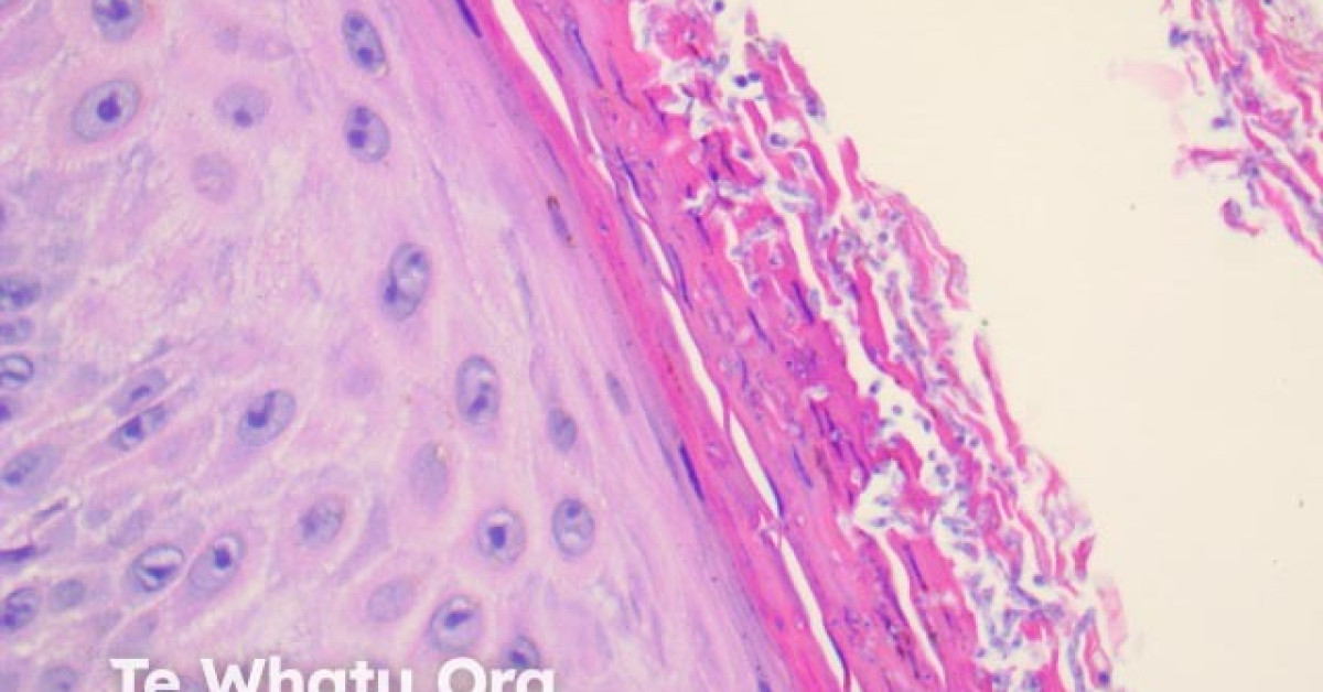 Tinea incognito pathology image