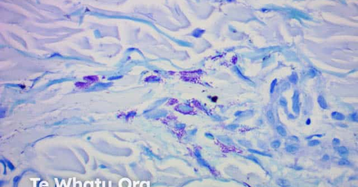 Toluidine blue stains mast cells purple in urticaria pigmentosa image