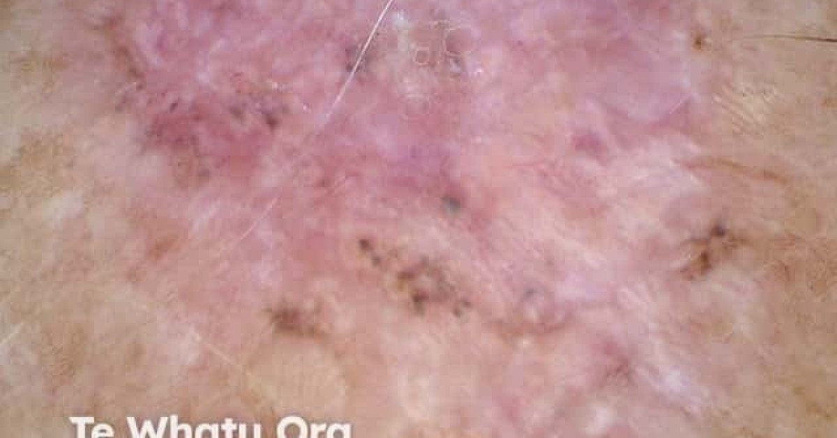 Perpendicular white lines, blue globule, leaf-like structures in ...