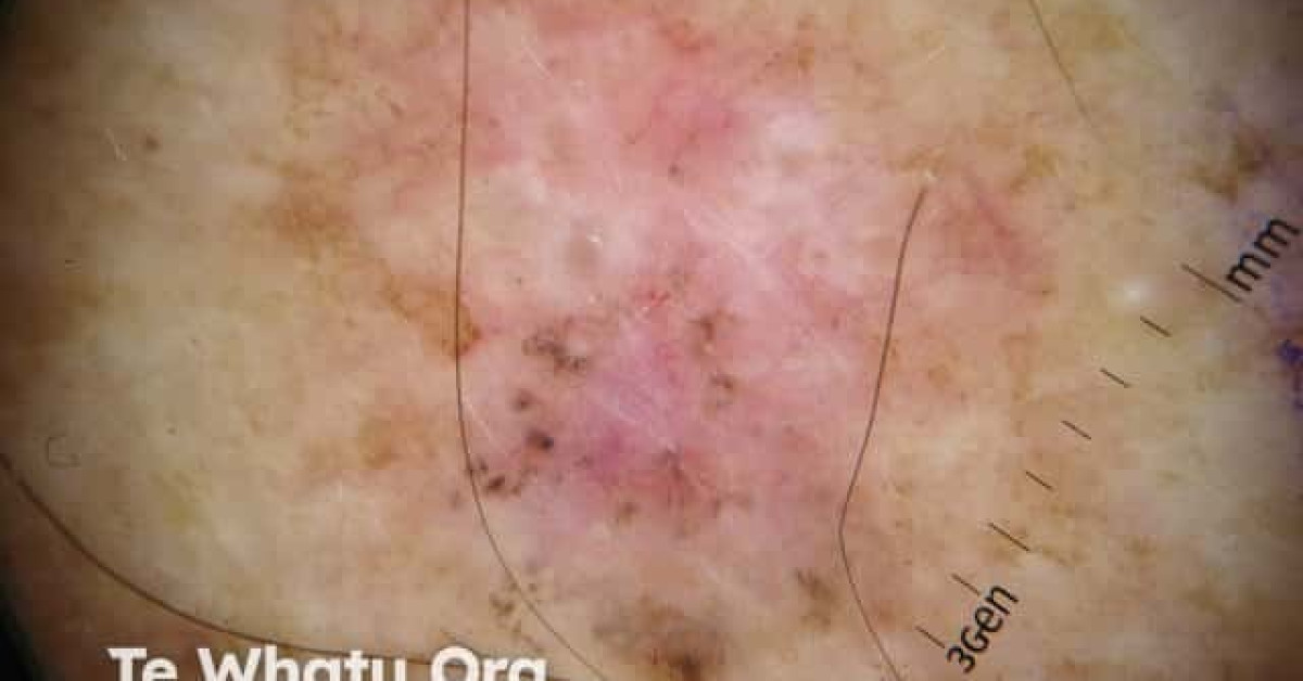 Pigmented basal cell carcinoma dermoscopy image