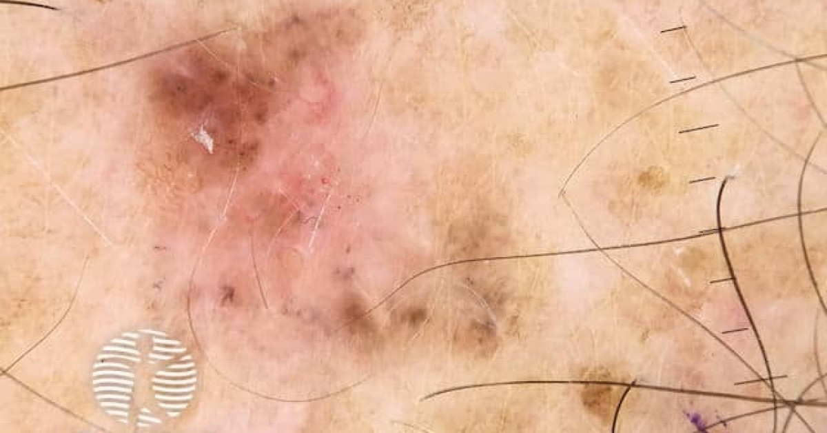 Pigmented basal cell carcinoma dermoscopy image