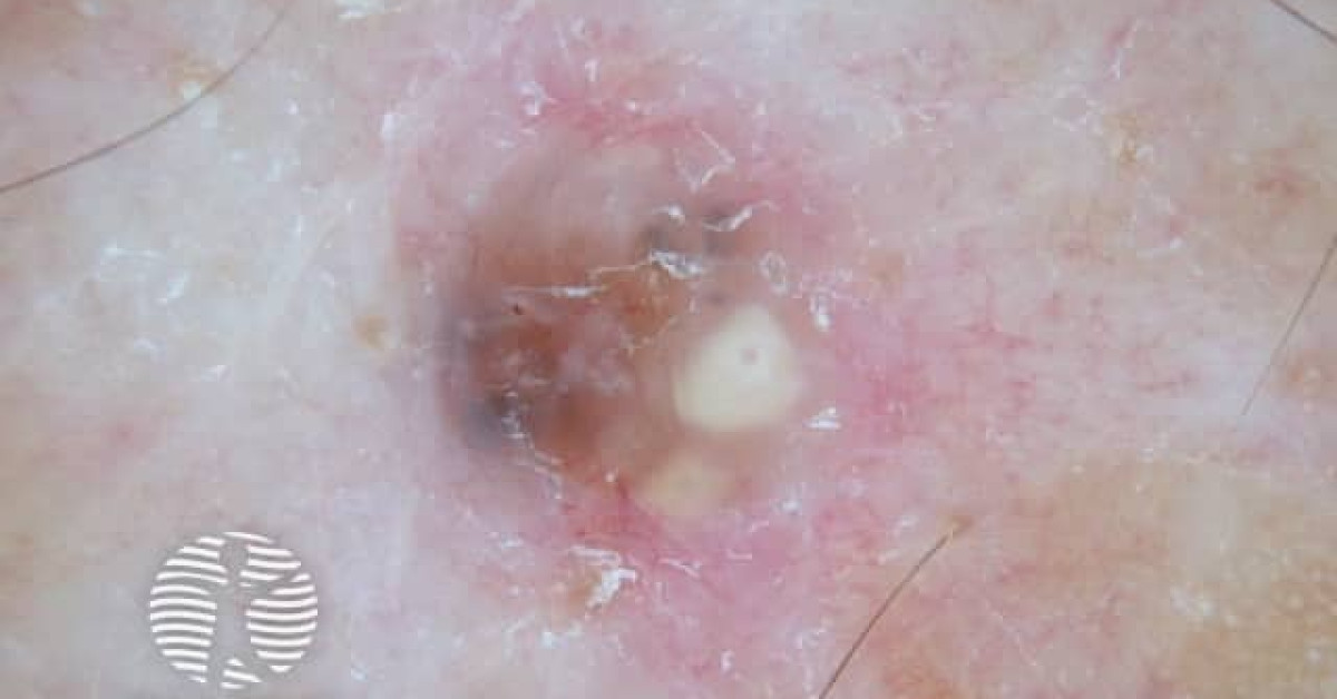 Pigmented basal cell carcinoma dermoscopy image
