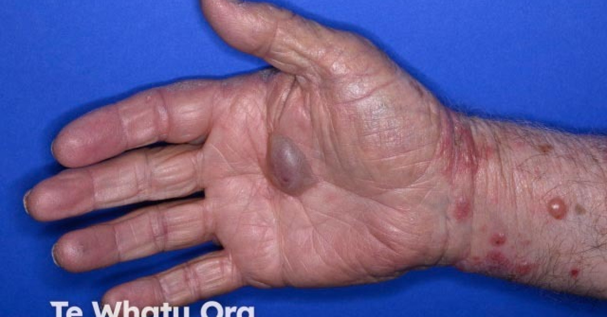 Bullous pemphigoid induced by pembrolizumab image