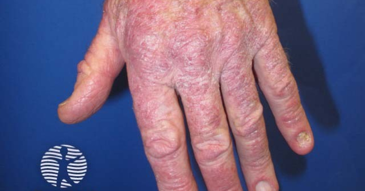 Pembrolizumab-induced psoriasis image