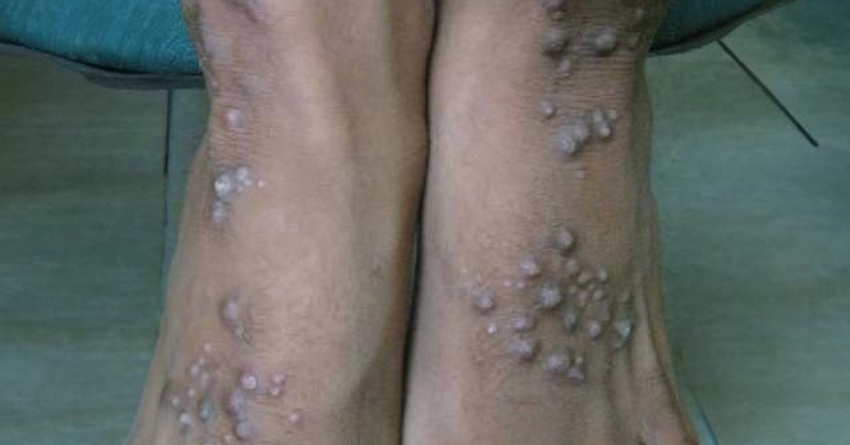 Pemphigoid nodularis image