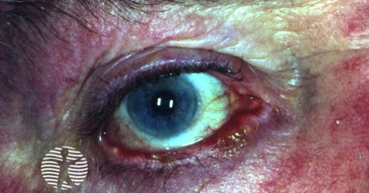 Pemphigus of eyelids image