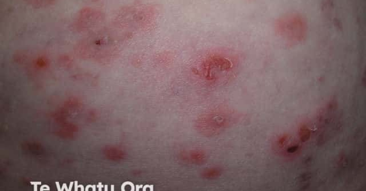 Pemphigus foliaceus blisters image