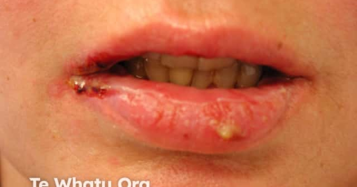 Pemphigus affecting lips image