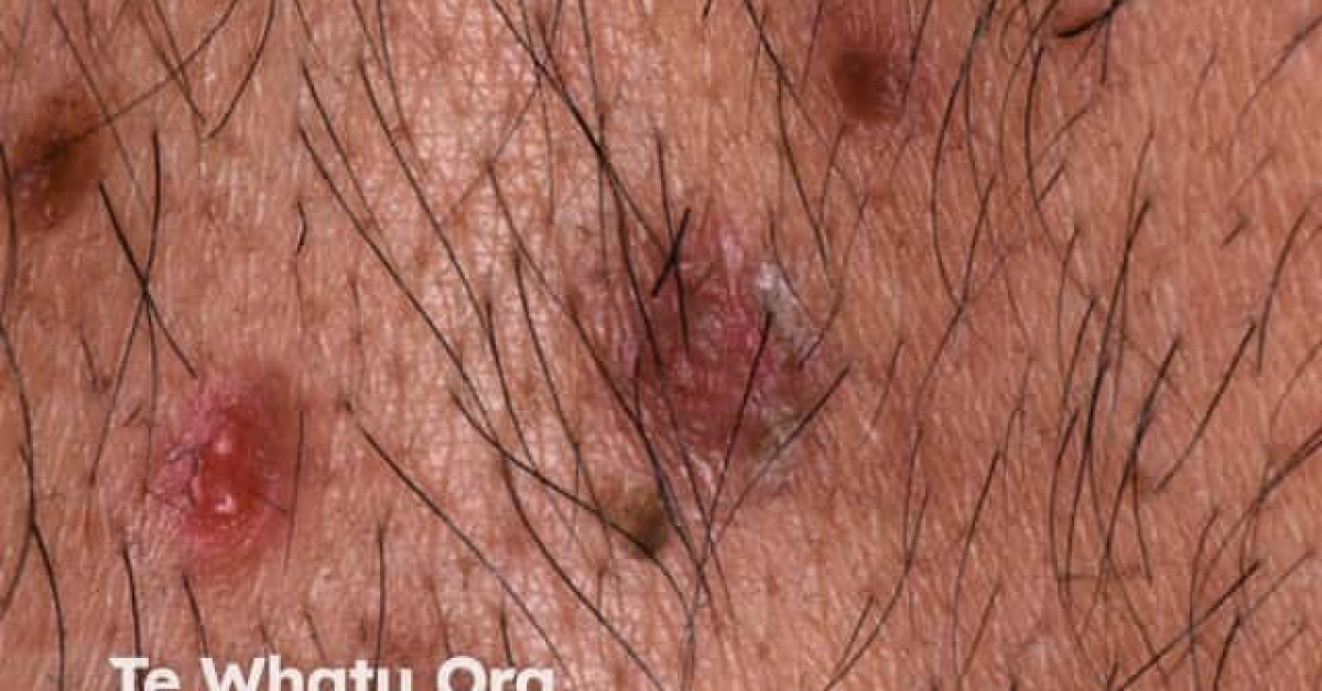 Pemphigus vulgaris image