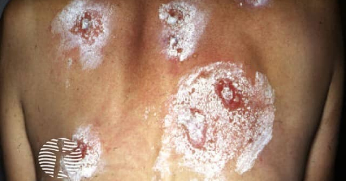 Pemphigus vulgaris image