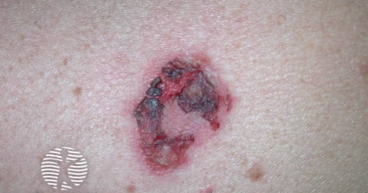 Pemphigus vulgaris image